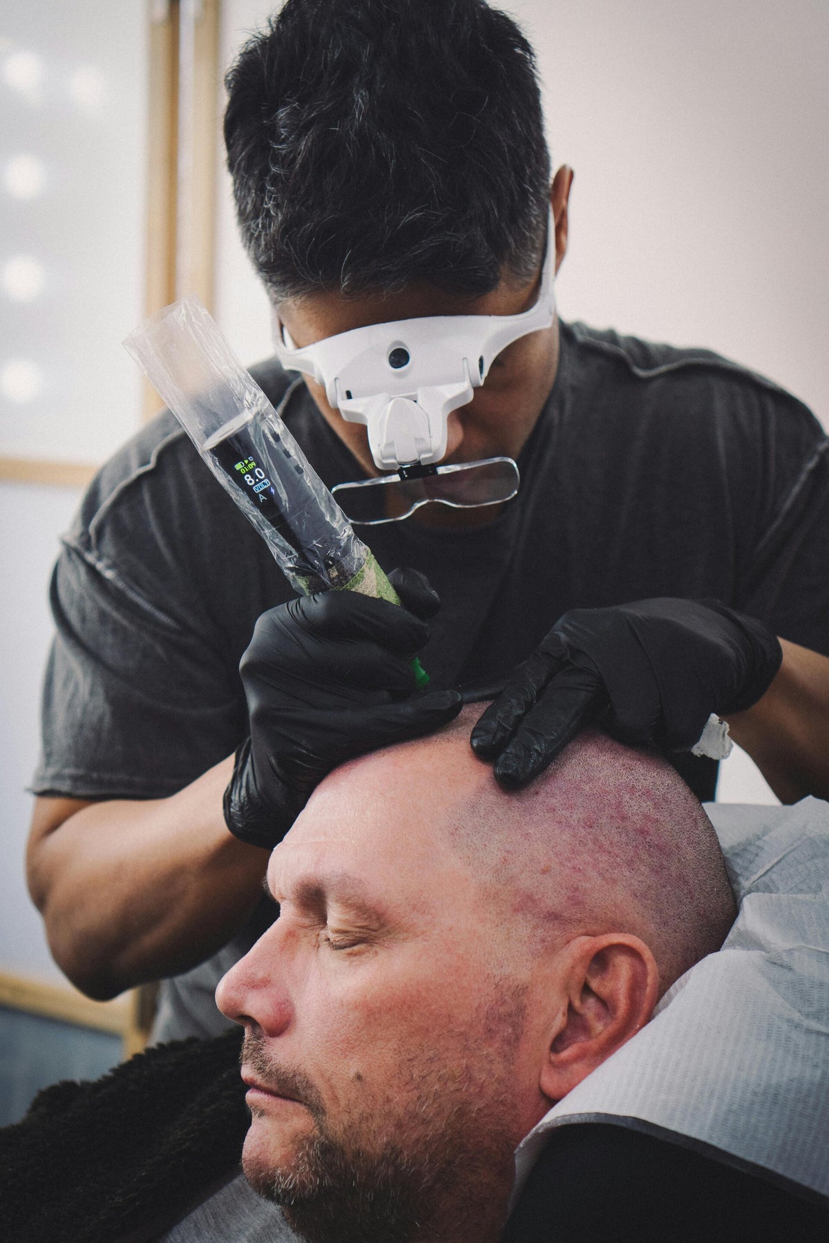 Scalp Micropigmentation (SMP) in Chorley | Pulsar