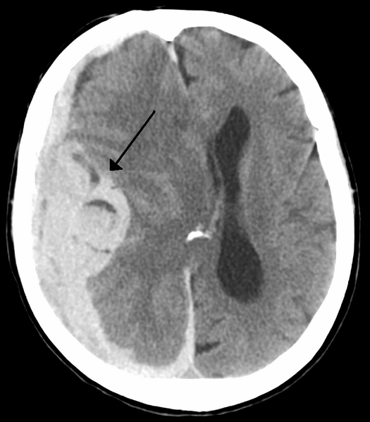 Cerebral edema - high brain pressure / Physical consequences ...