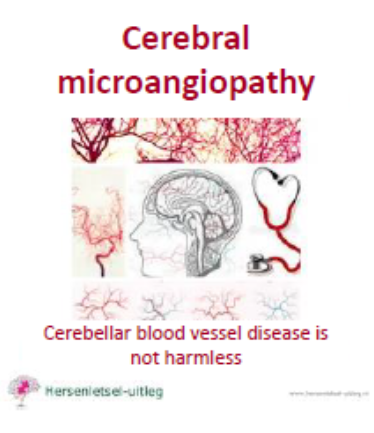 Microangiopathy / Stroke - CVA / Types of brain injury - brain ...