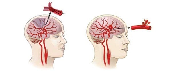 Stroke - CVA / Types of brain injury - brain disorders | Braininjury ...