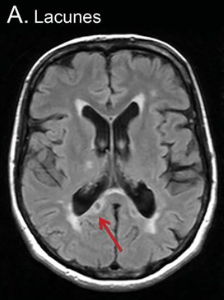 Small Vessel Disease / Cerebral Infarction / Stroke - CVA / Types of ...