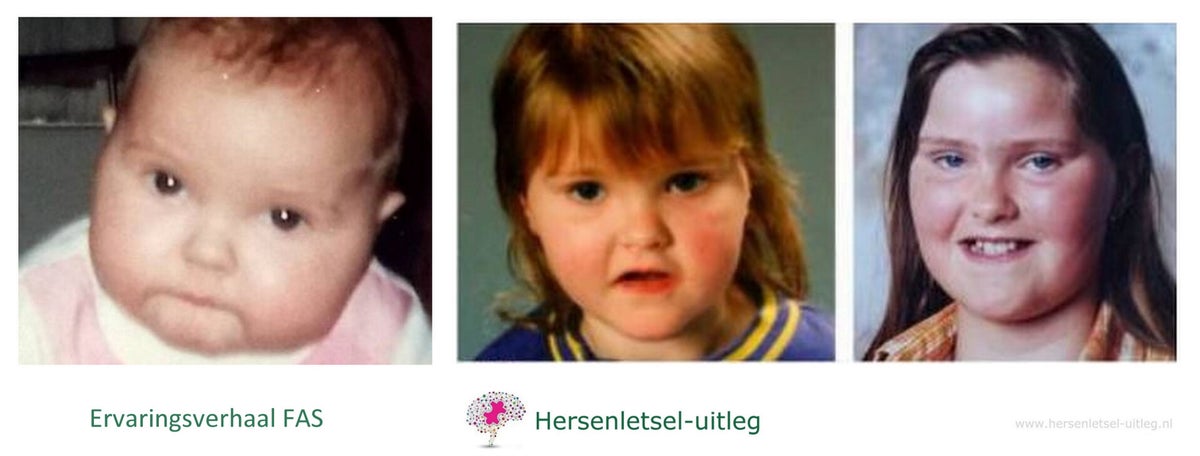 FASD Foetaal alcohol syndroom / Vanaf geboorte of kindertijd / Soorten ...