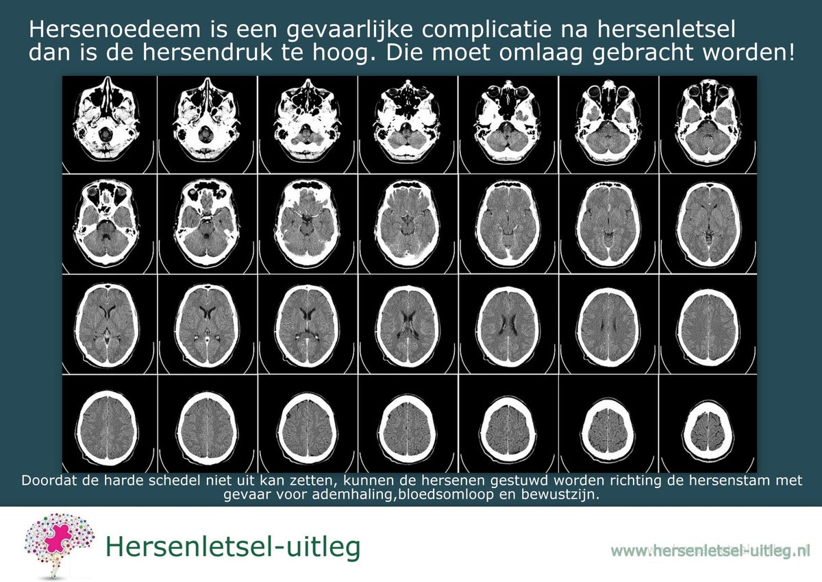 Hersenoedeem hoge hersendruk