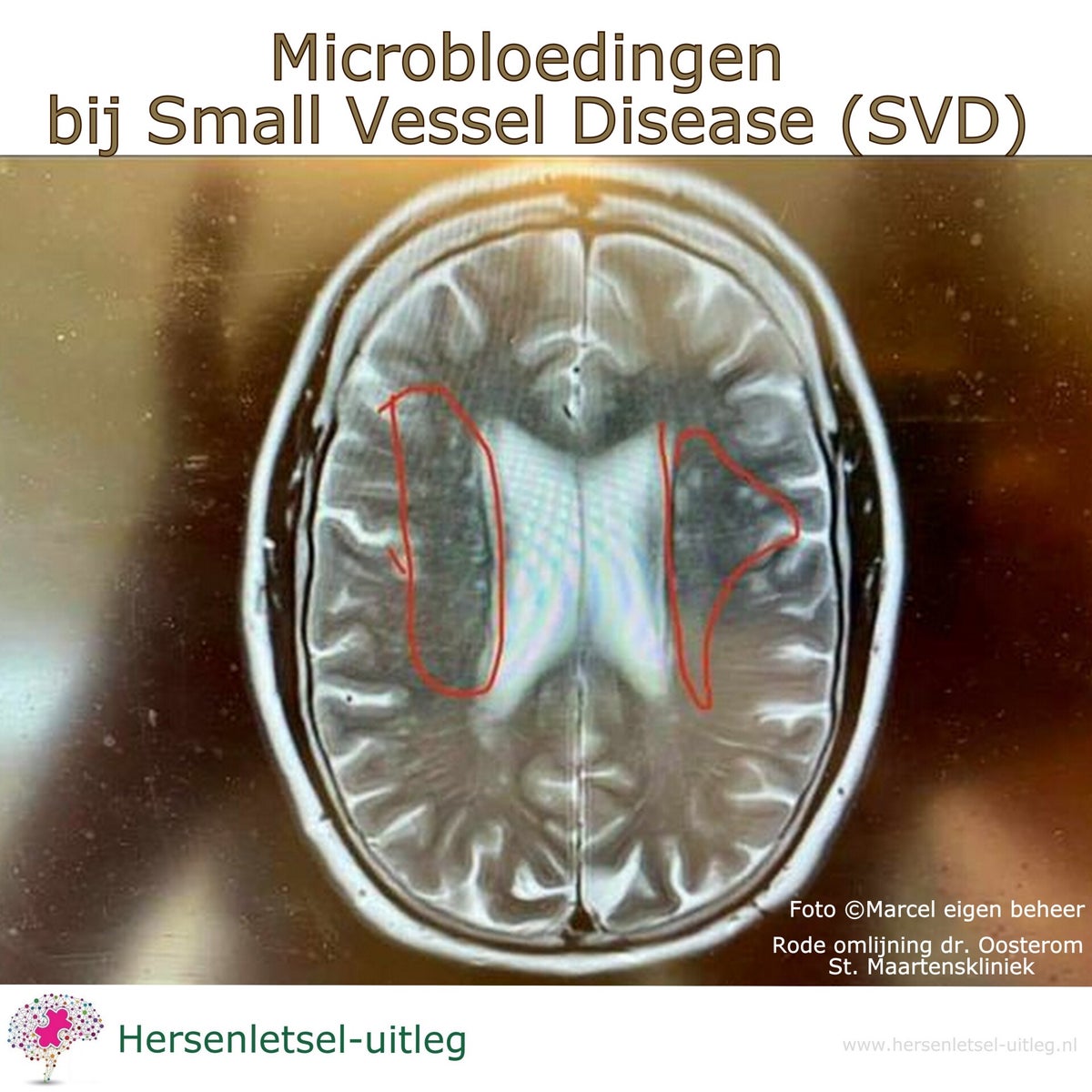 Small Vessel Disease / Herseninfarct / Beroerte CVA / Soorten hersenletsel hersenaandoeningen ...