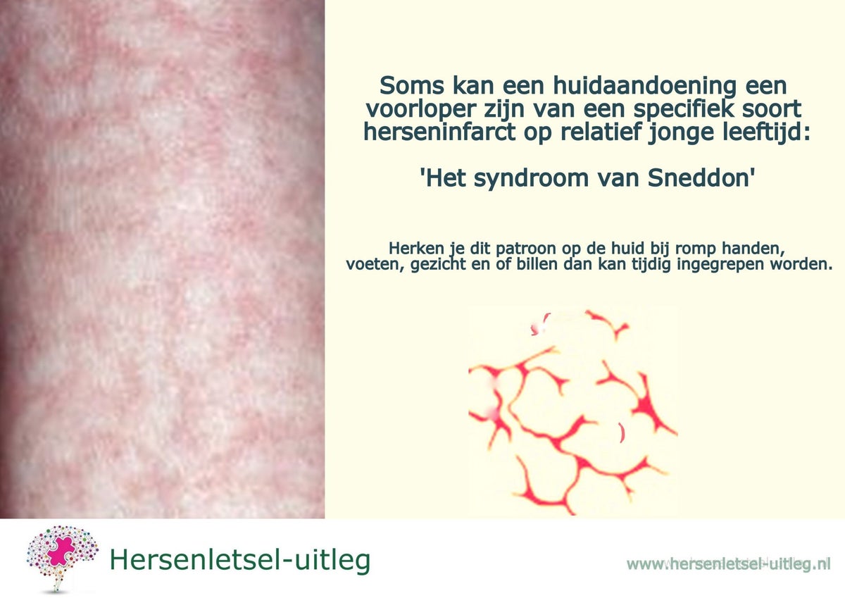 Syndroom van Sneddon