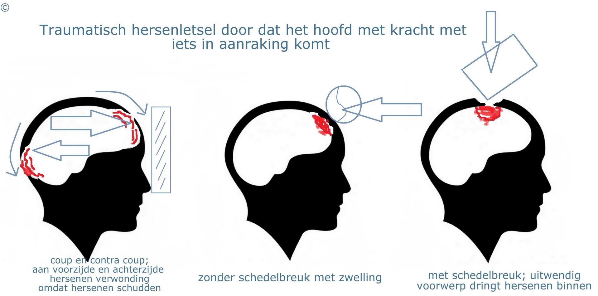 Traumatisch hersenletsel / Soorten hersenletsel hersenaandoeningen ...