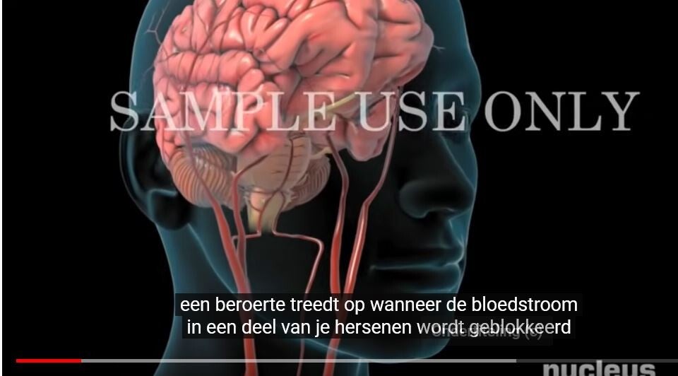 Herseninfarct / Beroerte CVA / Soorten hersenletsel hersenaandoeningen | Hersenletsel-uitleg.nl