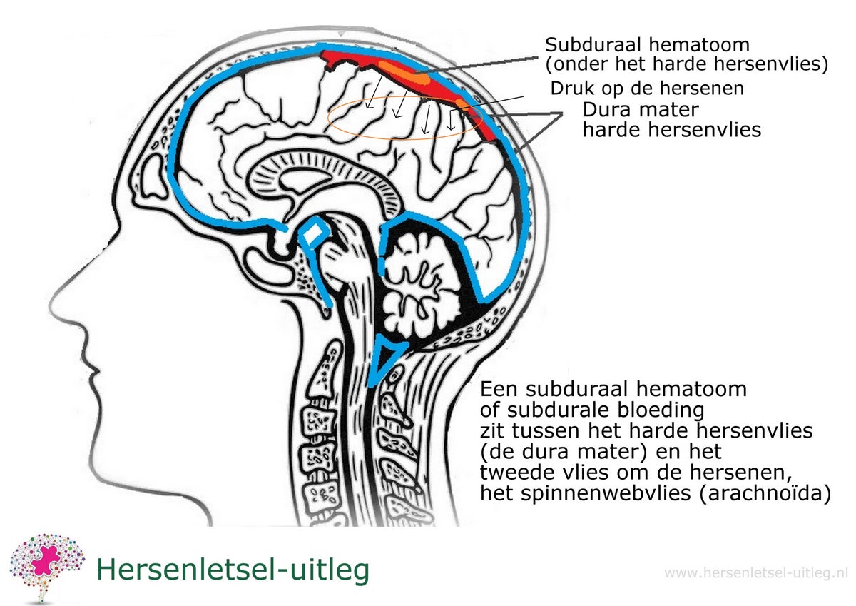 Subdurale bloeding / Subduraal hematoom / Hersenletsel door Beroerte ...
