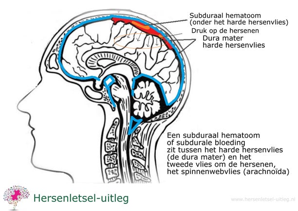 Subdurale bloeding / Subduraal hematoom / Hersenletsel door Beroerte ...