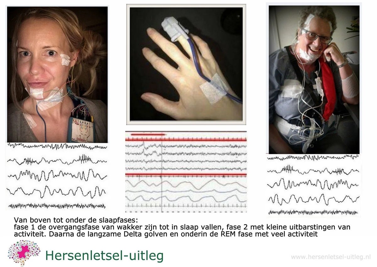 Slaapapneu / Lichamelijke gevolgen / Gevolgen | Hersenletsel-uitleg.nl