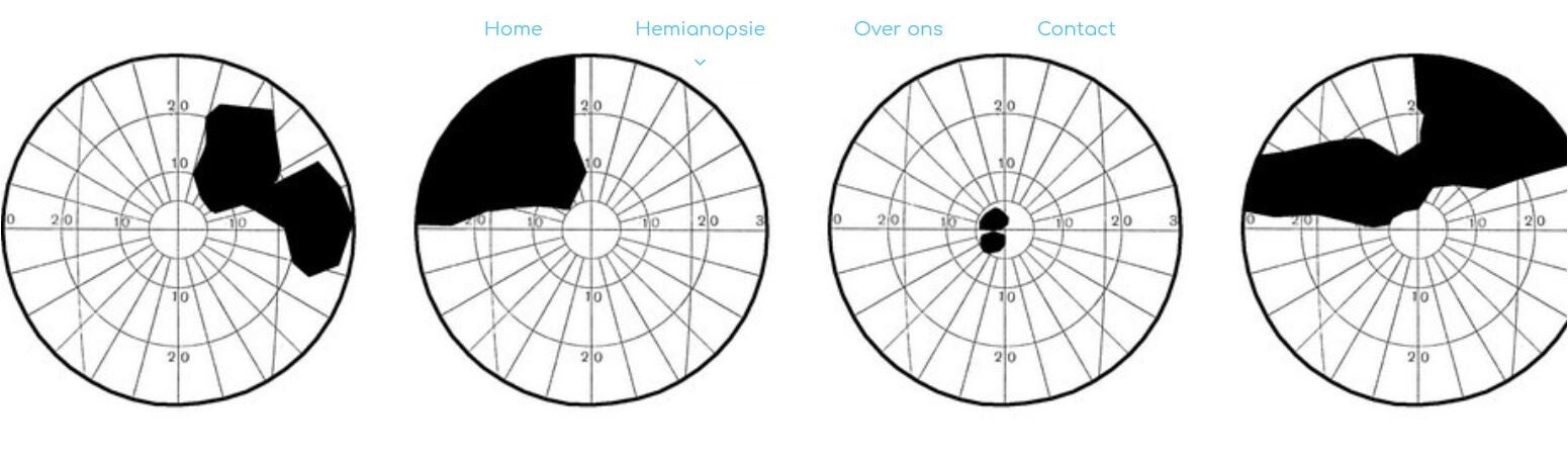 Hemianopsie / Visuele gevolgen bij hersenletsel / Zintuiglijke gevolgen ...