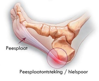 Fasciitis Plantaris (Peesplaatontsteking) - Podotherapie Enschede
