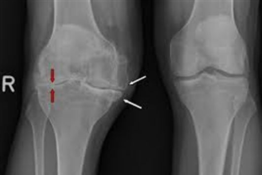 Knieprothese / Knie / Specialisaties | Orthopedie Geel