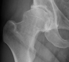 Totale heupprothese / Heup / Specialisaties | Orthopedie Geel