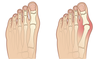 Hallux Valgus / Voet en enkel / Specialisaties | Orthopedie Geel