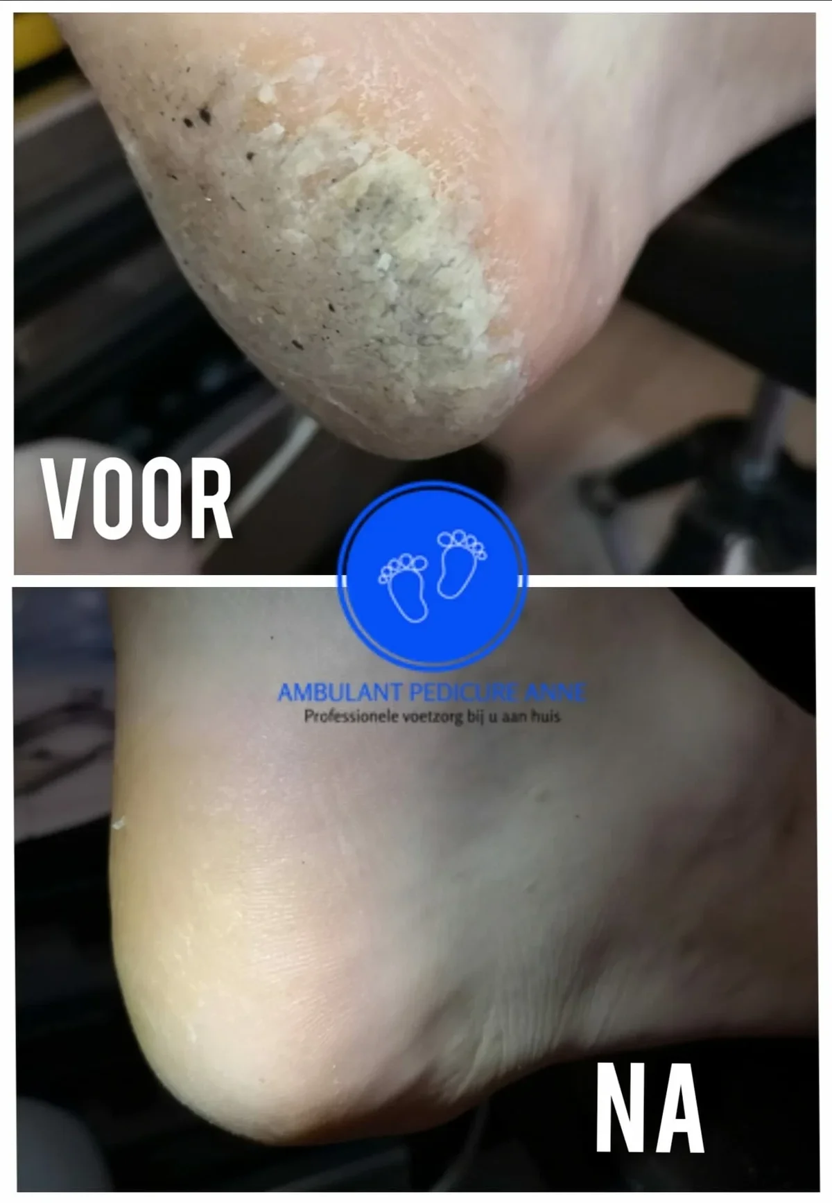 Behandelingen | Medisch pedicure praktijk Leende