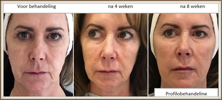 Profhilo (gezicht/hals/decolleté) / Huidverbetering | www.cynthia ...