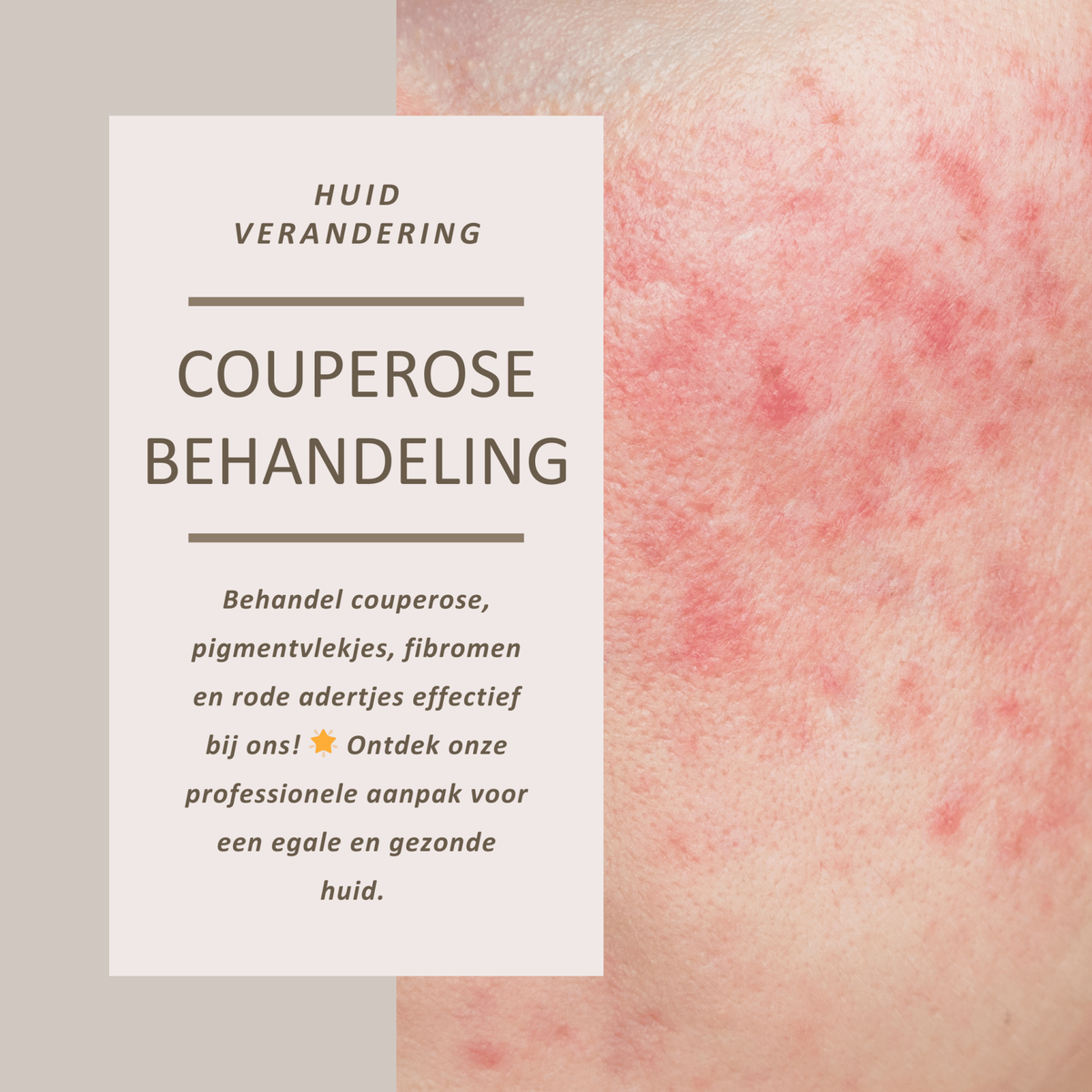 Couperose behandeling l Schoonheidssalon AltijdMooi in Maarssen