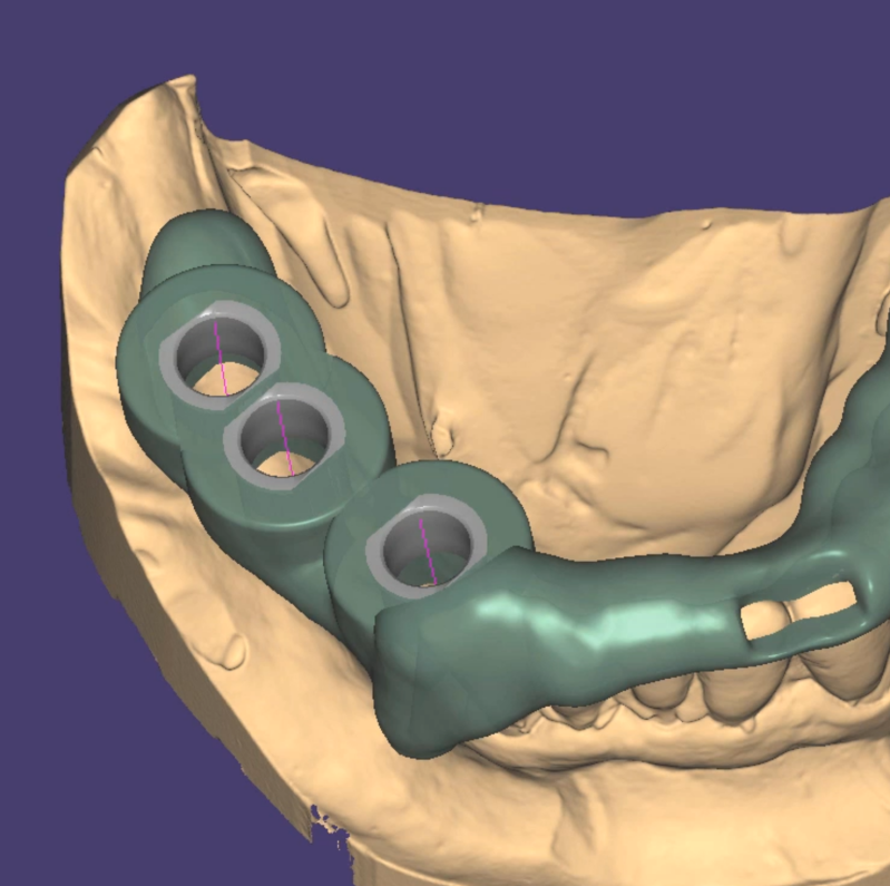 Surgical Guides CAD Design – Remote Dental Services