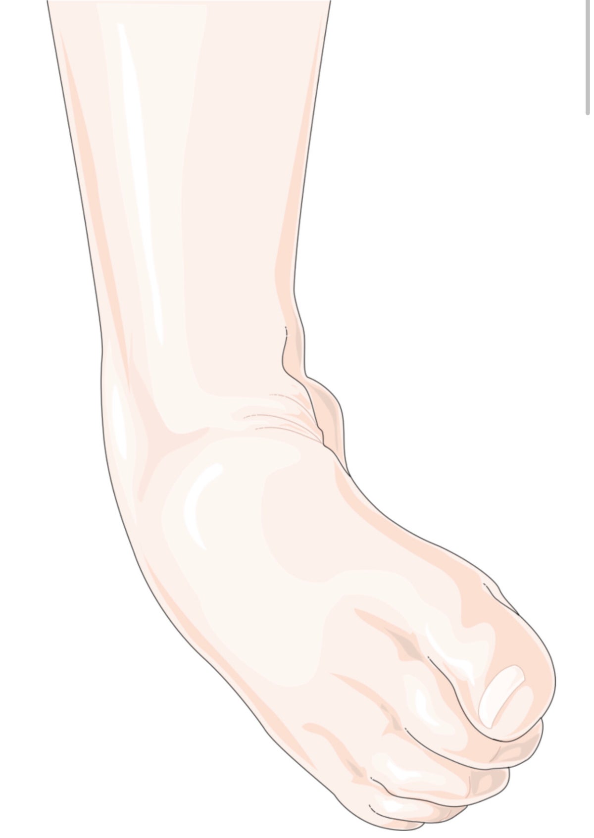 Ankle Sprains and Anterior Talofibular Ligament (ATFL) Reconstruction ...