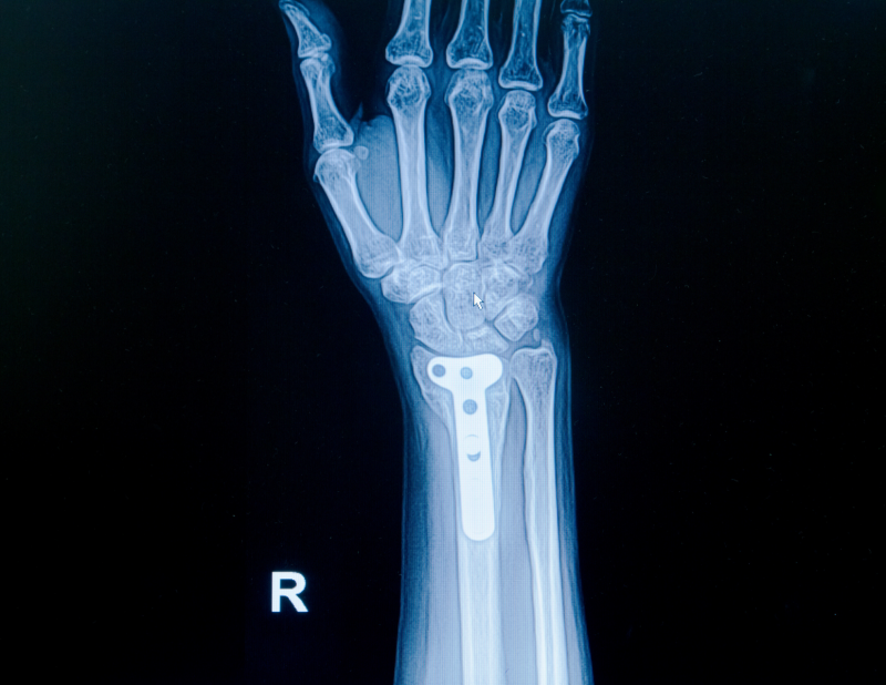 Wrist Fracture | Perfect Therapy