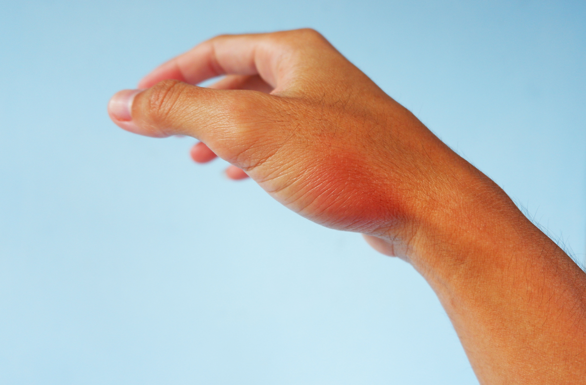 Thumb base Osteoarthritis /Rhizarthrosis / Blog | Perfect Therapy