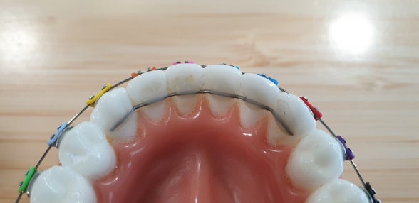 Retentie beugels / Soorten beugels / Alles over beugels | Orthodontist ...