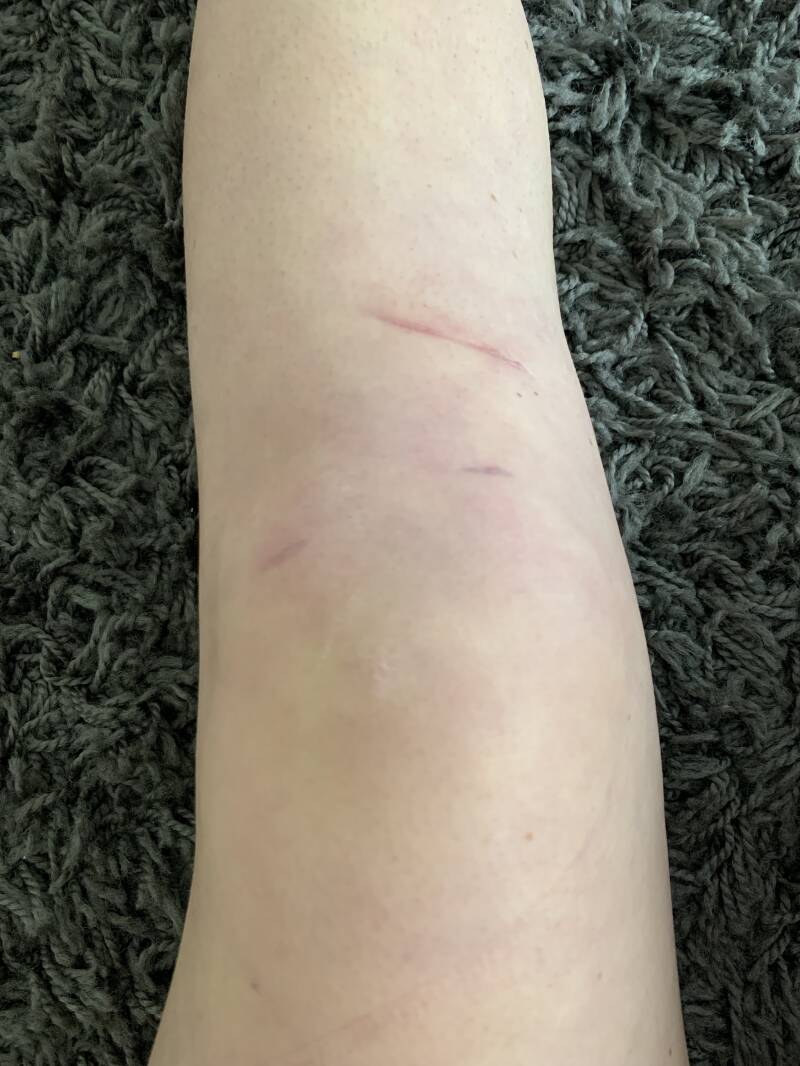Week 8 Summary / Blog | My ACL Journey