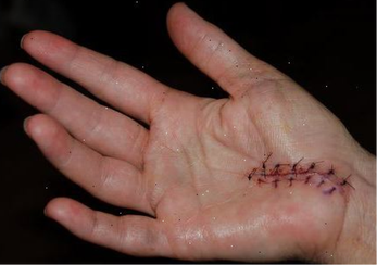 Carpaal tunnel syndroom operatie / Operaties neurochirurg / Behandeling ...