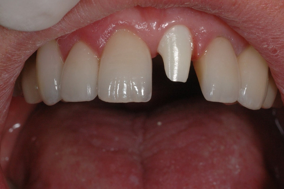 Hoe verloopt de behandeling kroon preparatie | Medicina Dentium ...