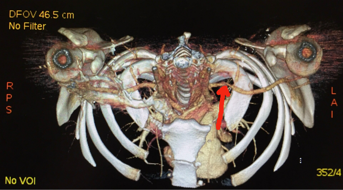 Das Thoracic Outlet Syndrom (TOS) | TOS-doc.ch