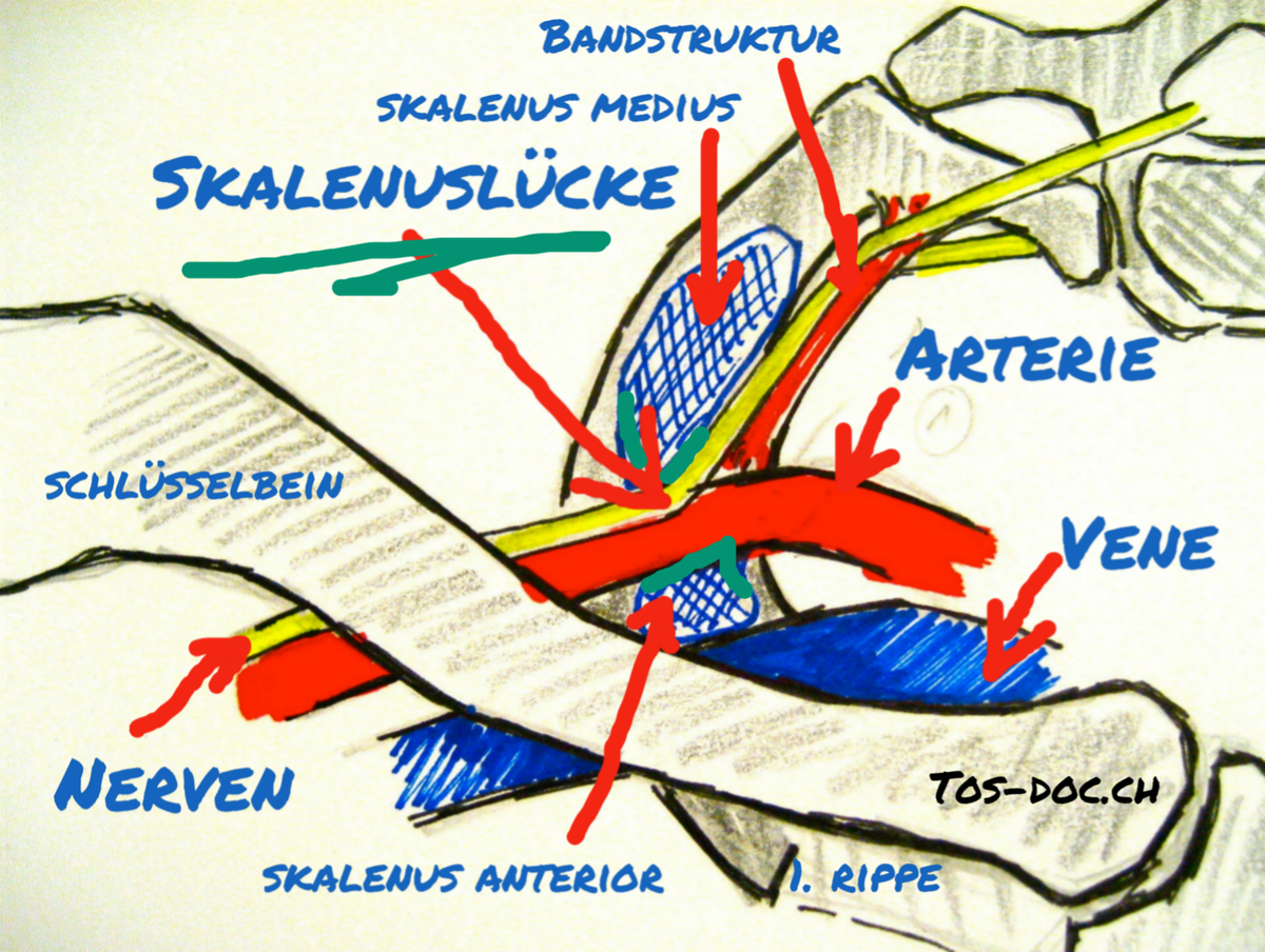 Das Thoracic Outlet Syndrom (TOS) | TOS-doc.ch