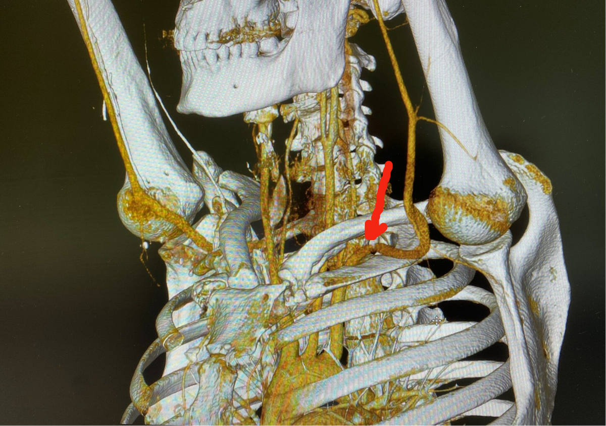 Das Thoracic Outlet Syndrom (TOS) | TOS-doc.ch