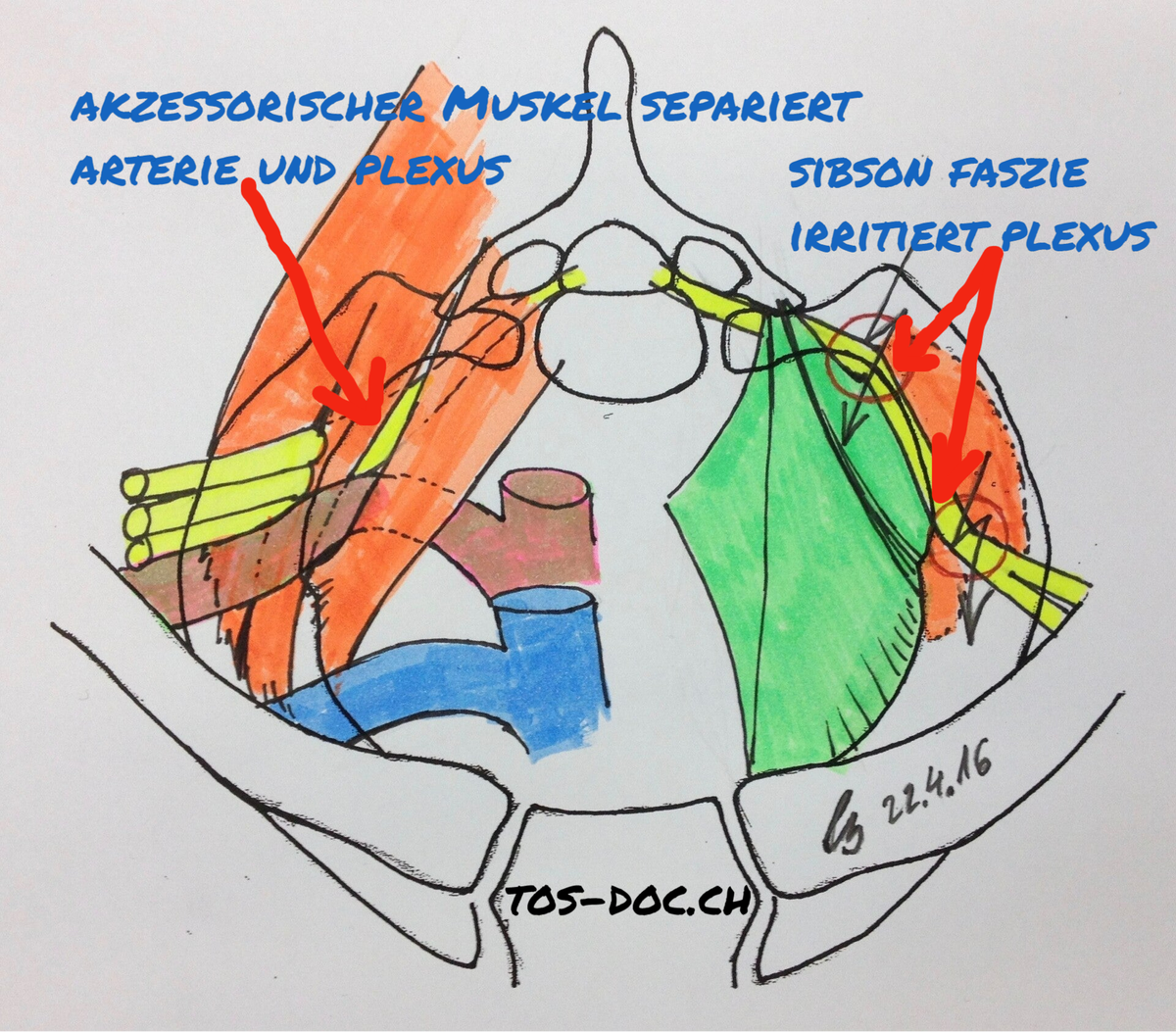 Das Thoracic Outlet Syndrom (TOS) | TOS-doc.ch