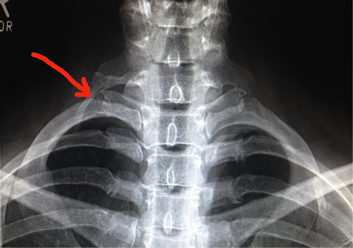 Das Thoracic Outlet Syndrom (TOS) | TOS-doc.ch