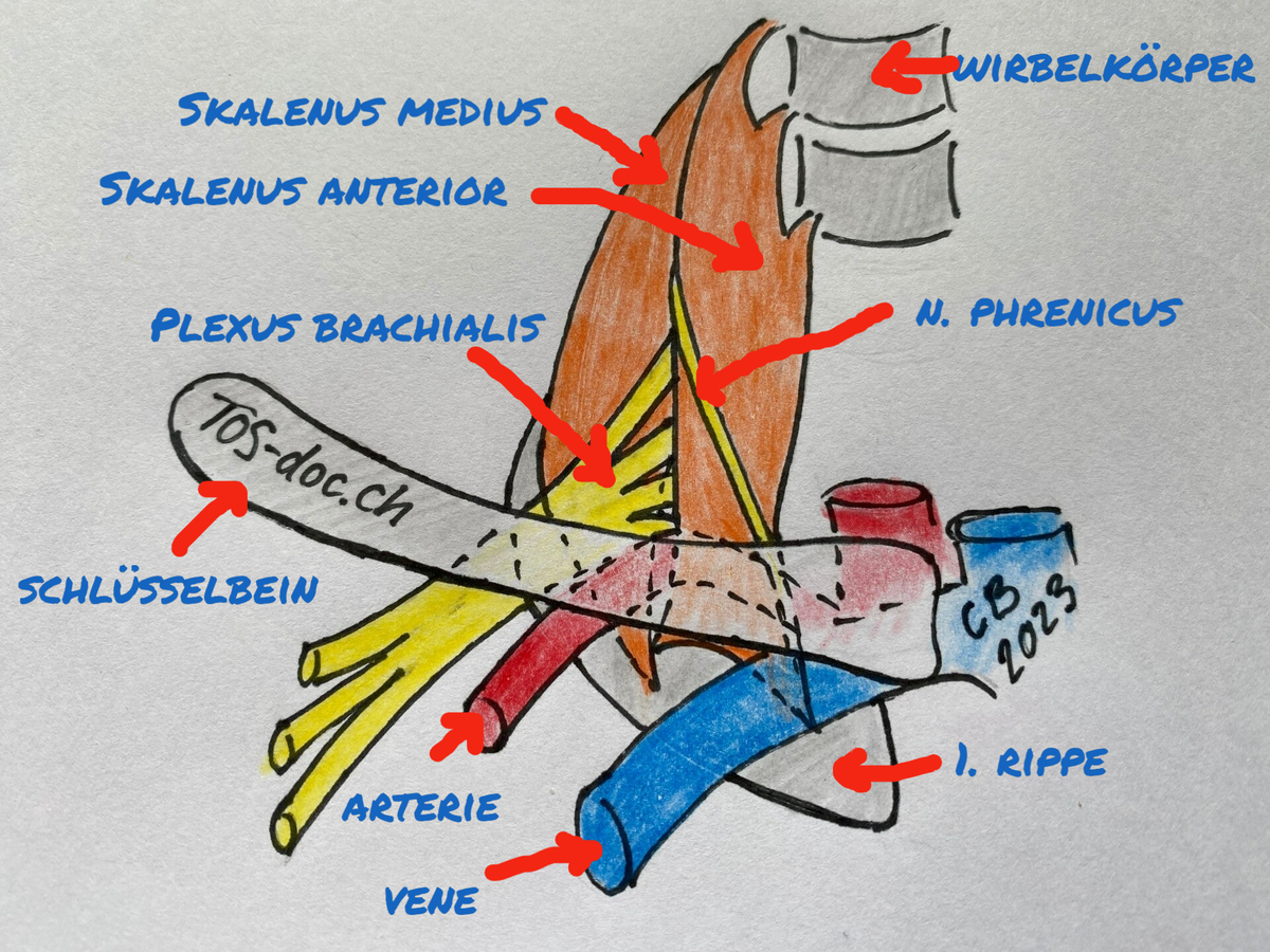Das Thoracic Outlet Syndrom (TOS) | TOS-doc.ch
