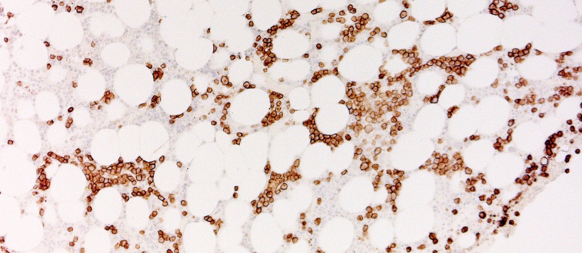 Korst and Tahri 2025 | Bone Marrow Browser