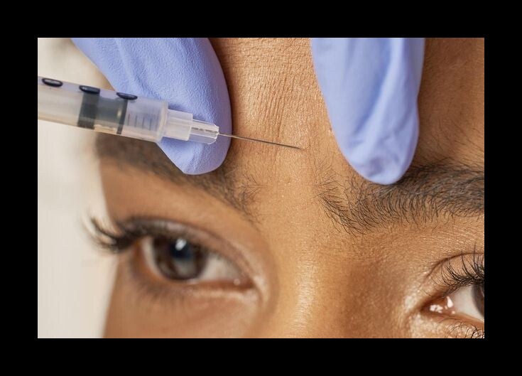Botox behandeling: advies & informatie | ANC Clinics