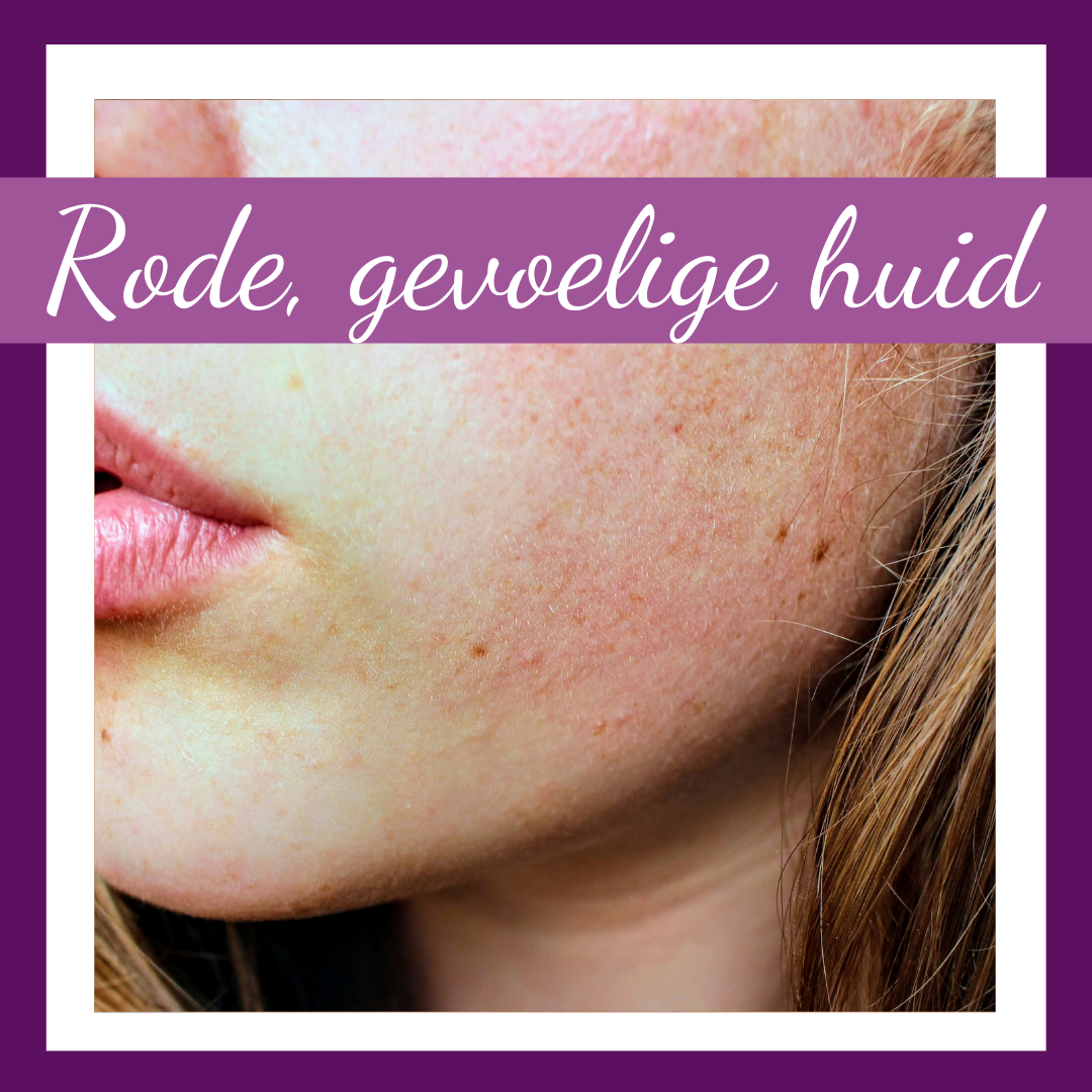 Rode huidproblemen / Huidproblemen | Huidinstituut Agnes