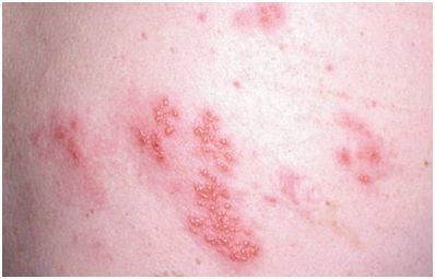 Puur Aloe Vera - Anti - schimmel crème | Pedicure Alies