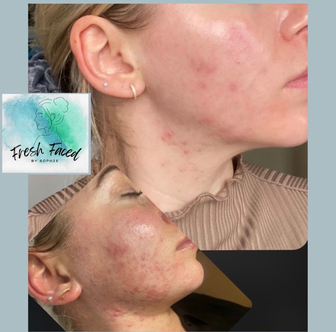 Fresh Faced Facials | freshfacedaestheticsbysophie.co.uk