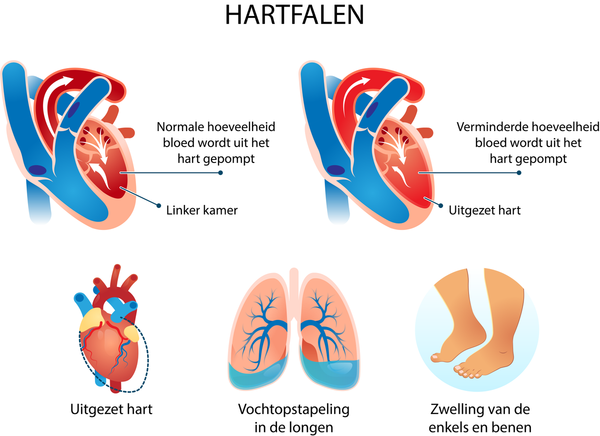 Hartziekten-Hartfalen / Patiënten-Hartziekten | Hartcentrum Ieper