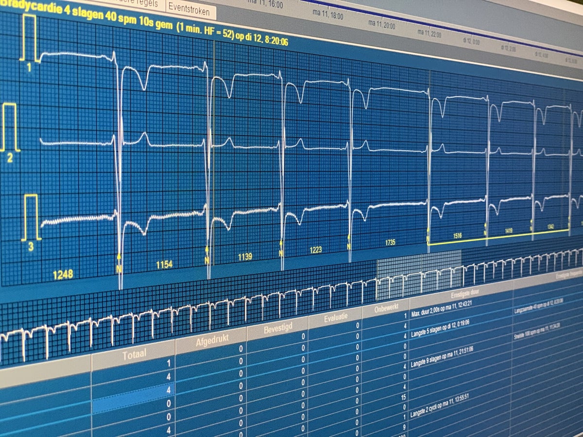 Hartritmestoornissen-tachycardie / Hartziekten-Hartritmestoornissen ...