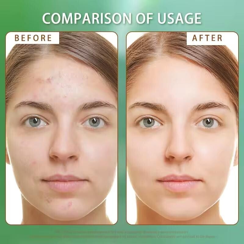 E'Yearn Korean Anti Acne Pimple Face Wash. | KCA Online Beauty Shop