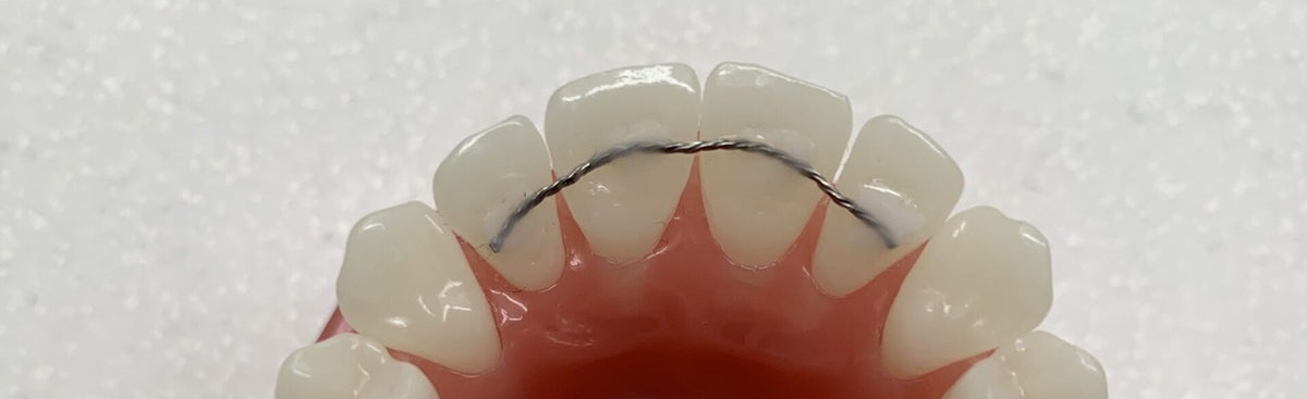 Retainers en Spalkjes / Behandelingen | Ben's Orthodontie Bv